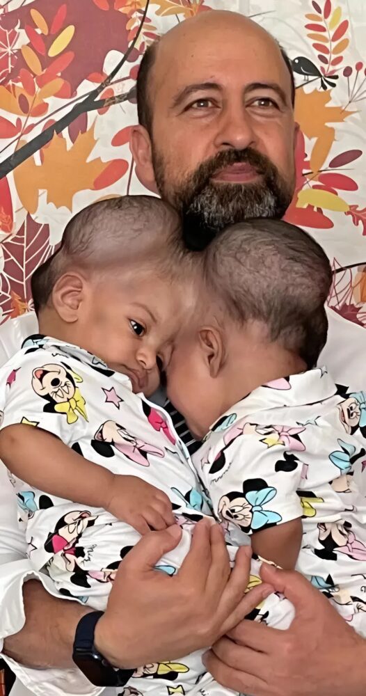 A historic operation separated craniopagus conjoined twins, thanks to ...
