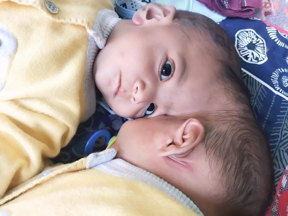 A historic operation separated craniopagus conjoined twins, thanks to ...
