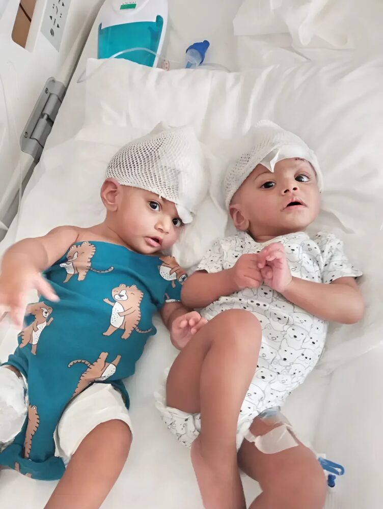 A historic operation separated craniopagus conjoined twins, thanks to ...